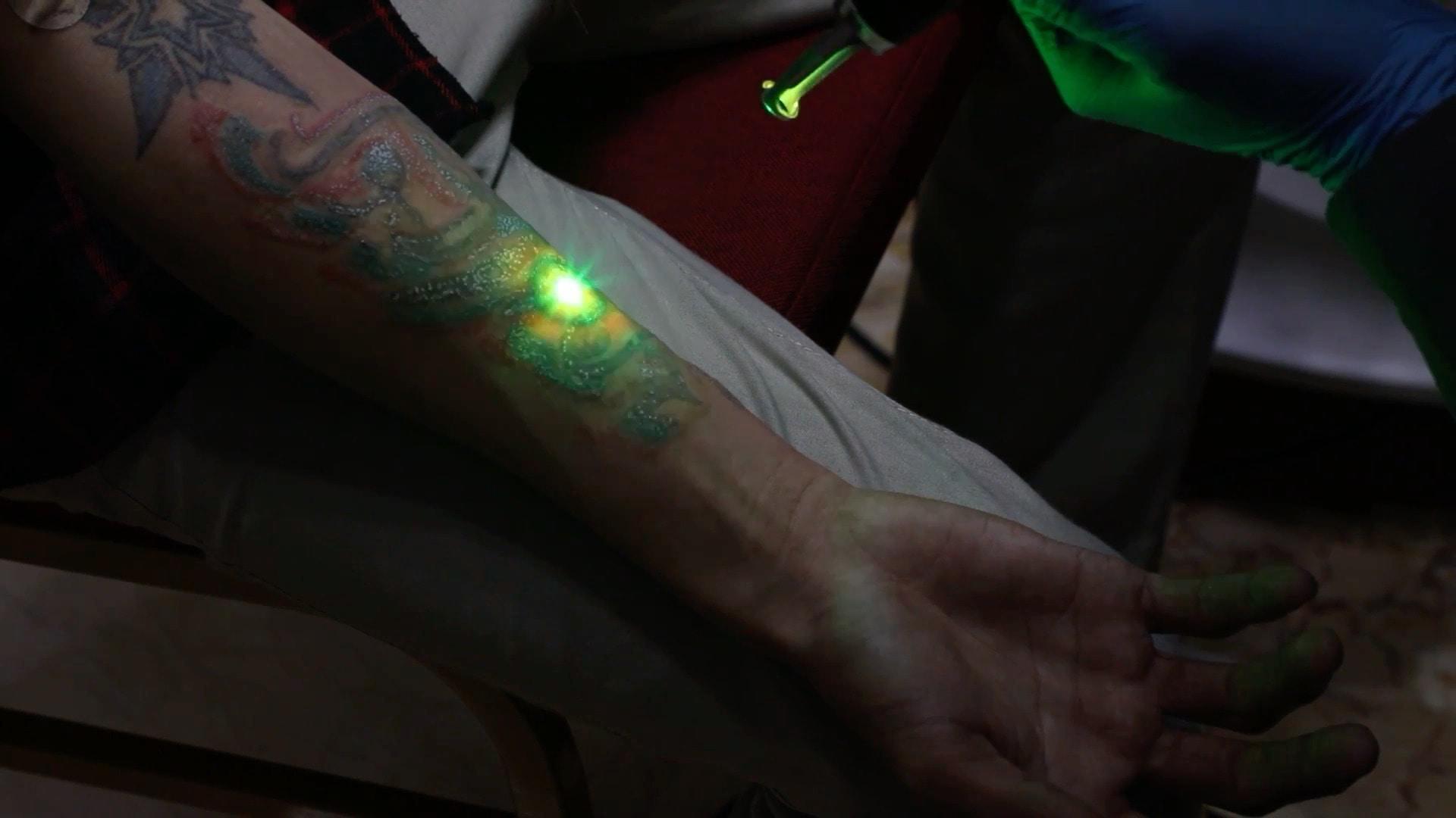 Inked no more! - Muslims in Jakarta get tattoos removed to repent ...